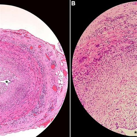 Histopathology Of Superficial Temporal Artery Biopsy Showing A