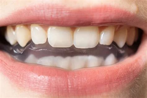A Comprehensive Guide To Tmj Splint 56 Off