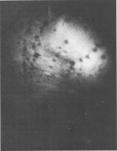 Endoscopic Photograph Of The Rectosigmoid Region In Case I Numerous Download Scientific