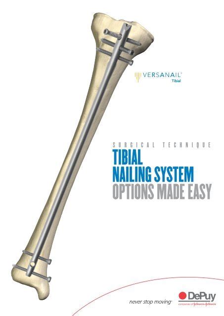 Versanail Tibial Nailing System Surgical Technique Biomet