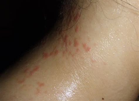 Red Itchy Rashes On Neck Ask Metafilter