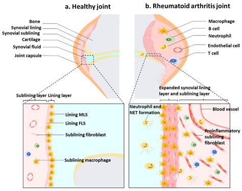 Arthritis Tissue Analysis At Joy Herman Blog