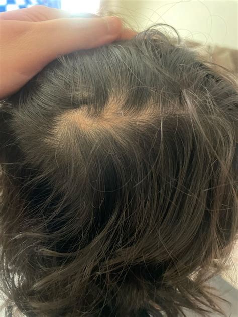 Scalp Birthmark Nevus Sebaceus R Dermatologyquestions