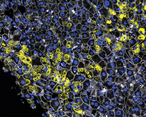 Ai Assisted Proteomics Investigates Rare Liver Disease