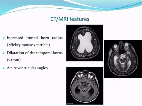 CSF Circulation Disorders PPTX