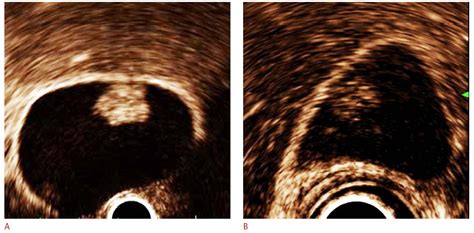 Gallbladder Polyps Causes Symptoms Cancer Radiology Treatment