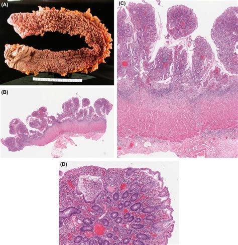 Overview Of Histopathology Of Ulcerative Colitis And Crohns Disease Clinical Tree