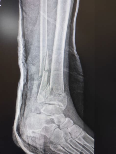 Dr Mahmoud Fahmy On Linkedin This Fracture Makes Me Remember T Fracture Type Of Acetabular…