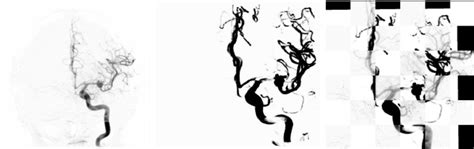 1a A 2d Max Image Produced From A 2d Dsa Image 1b A Mip Of The