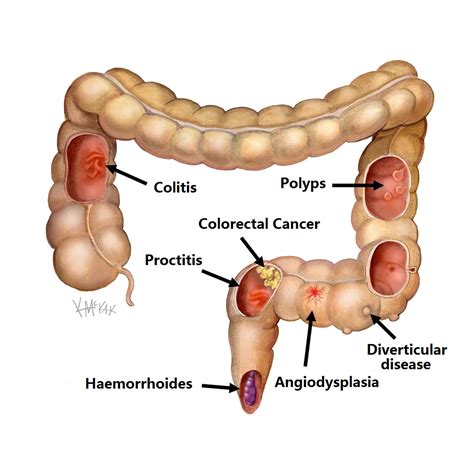 Rectal Bleeding Gut And Gastroenterology