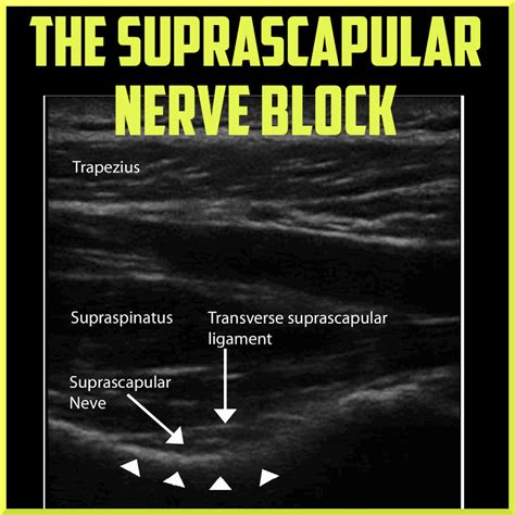 The Suprascapular Nerve Block Sports Medicine Review
