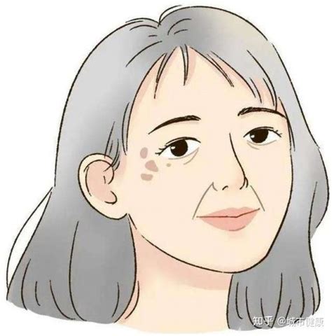 脸上长老年斑是什么原因引起的脸上老年斑怎样才能彻底的去掉 知乎