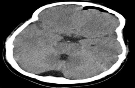 Unilateral Pneumocephalus And Enlarged Occipital Fossa Ct Scan Axial