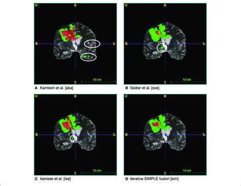 Single Algorithm Vs Iterative Simple Consensus Segmentation T2 Download Scientific Diagram