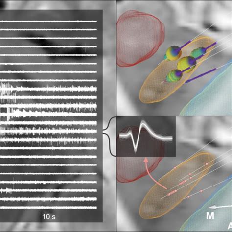 Example Case Showing Trajectories Microelectrode Recordings Mer