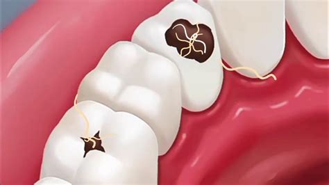 Teeth Cavity 🦷🦷🦷 Feeling Animation And Toung Cleansing👅 Animation Video