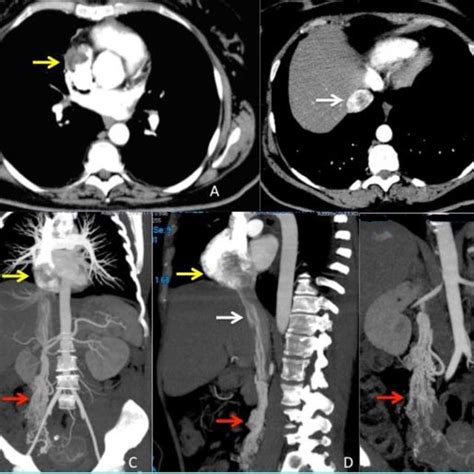 Ct Scan Images A B Arterious Phase Showing The Defect Inside Right