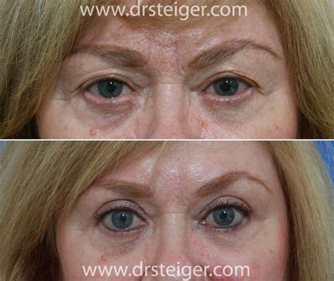 Pin On Eyelid Correction