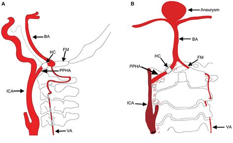 Frontiers Case Report Persistent Primitive Hypoglossal Artery