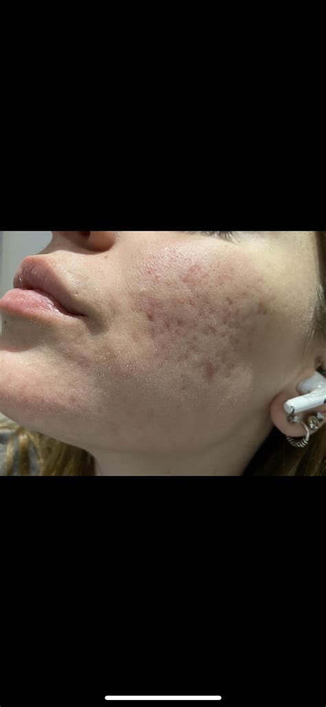 Accutane Saved My Face Be Patient Guys Raccutane