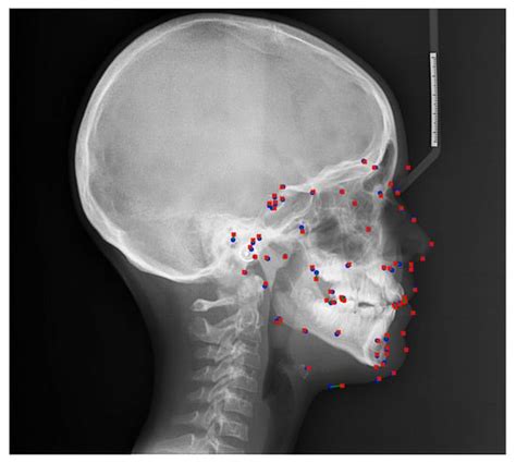 Cephalometric Landmark Detection In Lateral Skull X Ray Images By Using