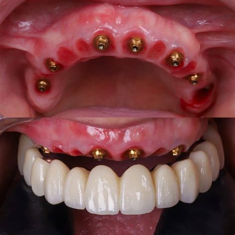 Prótesis Fija Sobre 6 Implantes Información Y Precio