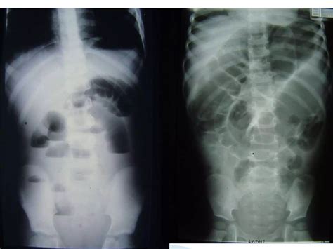 Neonatal Intestinal Obstruction Pptx