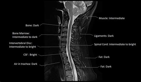 Flair Vs Stir Mri Flair Vs Stir Mri Image Comparison