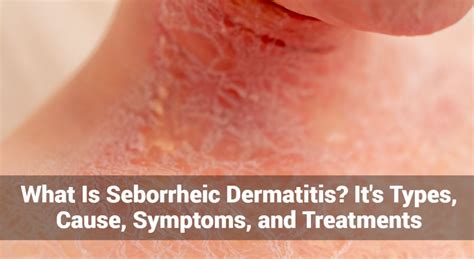 What Is Seborrheic Dermatitis Its Types Cause Symptoms And