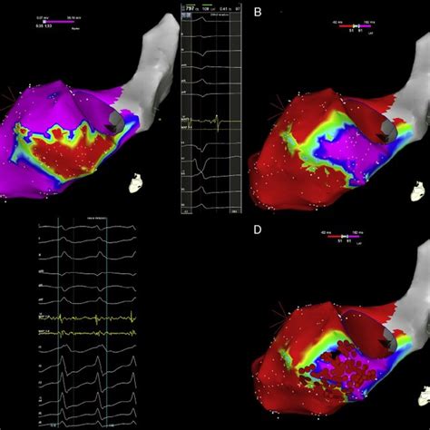 Techniques For Substrate Ventricular Tachycardia Ablation A The