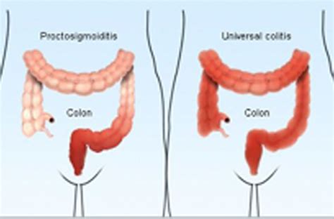 Ulcerative Proctitis