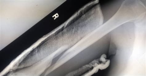 Spiral Fracture Treatment Spiral Bone Fracture Surgery