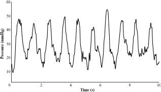 Pulsatile Waveform This Is An Arterial Pressure Waveform Of Pulsatile Download Scientific