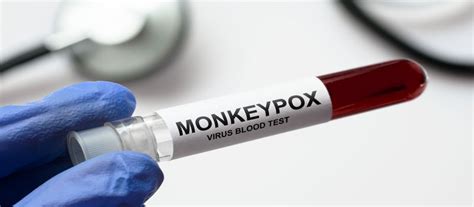 Seberapa Serius Virus Cacar Monyet Holisticare