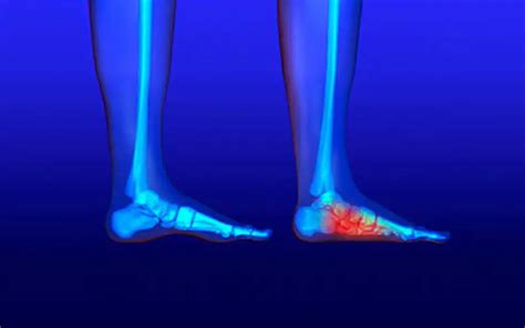 صافی کف پا Flat Feet بدن خوبا