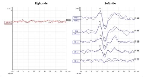 CVEMP Testing Showed Absence Of P1 N1 Complex For The Right Side Download Scientific Diagram