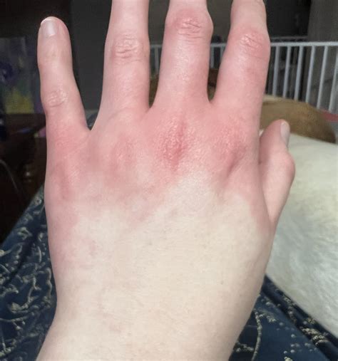 40 Best R Erythromelalgia Images On Pholder Anyone Elses Camera Roll Look Like This