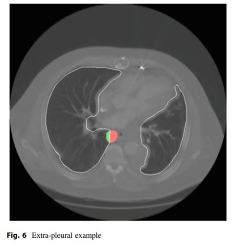 A Clinically Viable Approach To Lung Segmentation And Nodules Reinclusion Nuven