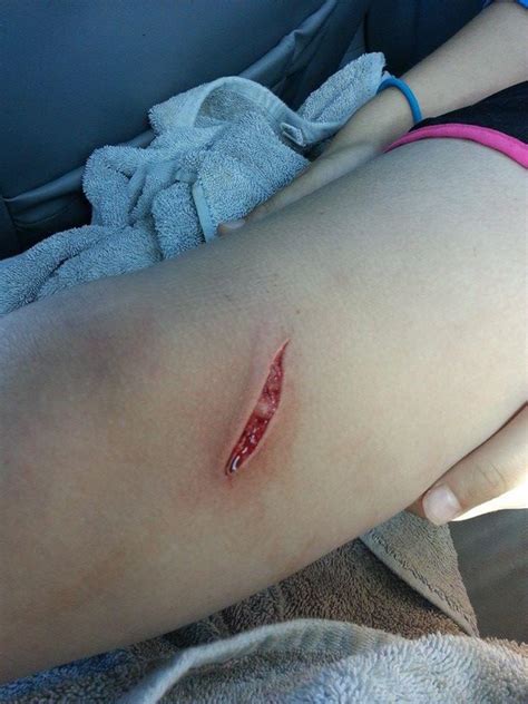 SFW Socotra Dragon Tree NSFW Open Wound By The Knee R FiftyFifty