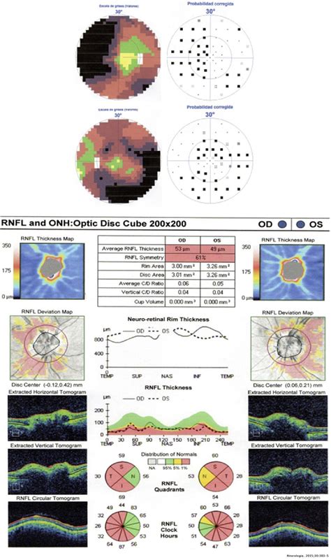 Neurological Visual Field Defect