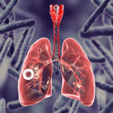 Tuberculosis Transmission And Treatment