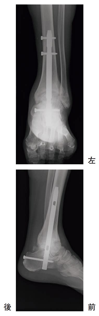 76歳の男性。左足関節の痛みに対して手術療法が行われた。術後エックス線写真を別に示す。