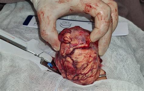 Dr Maurício Muniz Tumor Gist Dr Maurício Muniz