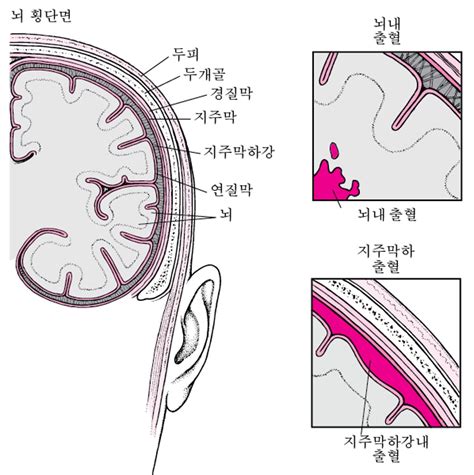 뇌내출혈 뇌 척수 신경 장애 Msd 매뉴얼 일반인용