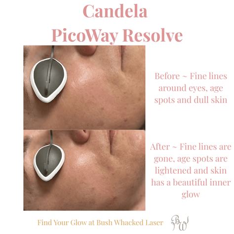 Picosecond Laser Revolutionizing Skin Rejuvenation Bush Whacked Laser