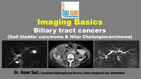 Cholangiocarcinoma Ultrasound