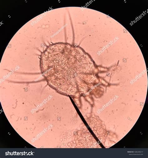 Sarcoptes Scabiei Skin