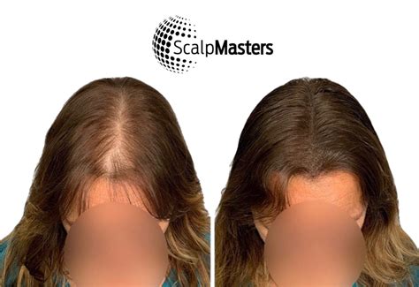 Does Smp Work For Women Scalpmasters Does Smp Work For Women Scalpmasters
