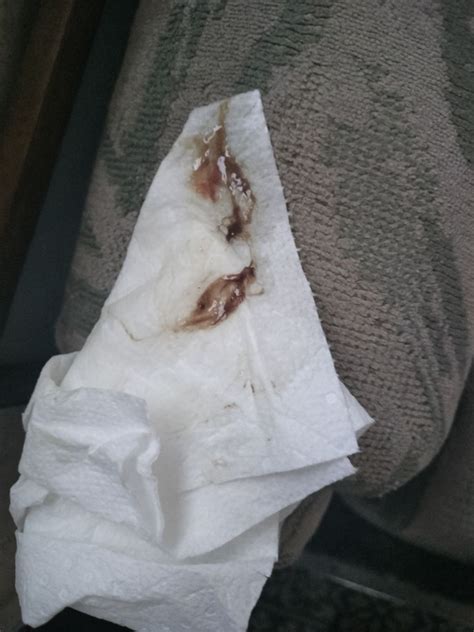 Brown Mucus After Implantation Bleeding