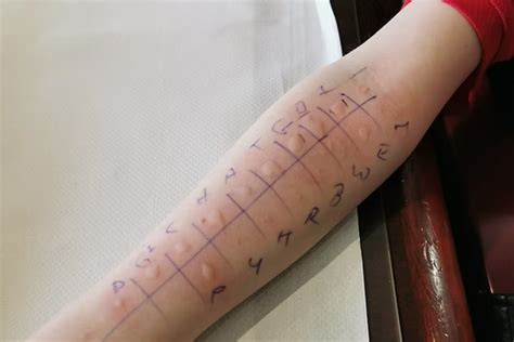 Skin Allergy Testing Daher Asthma And Allergy Clinic